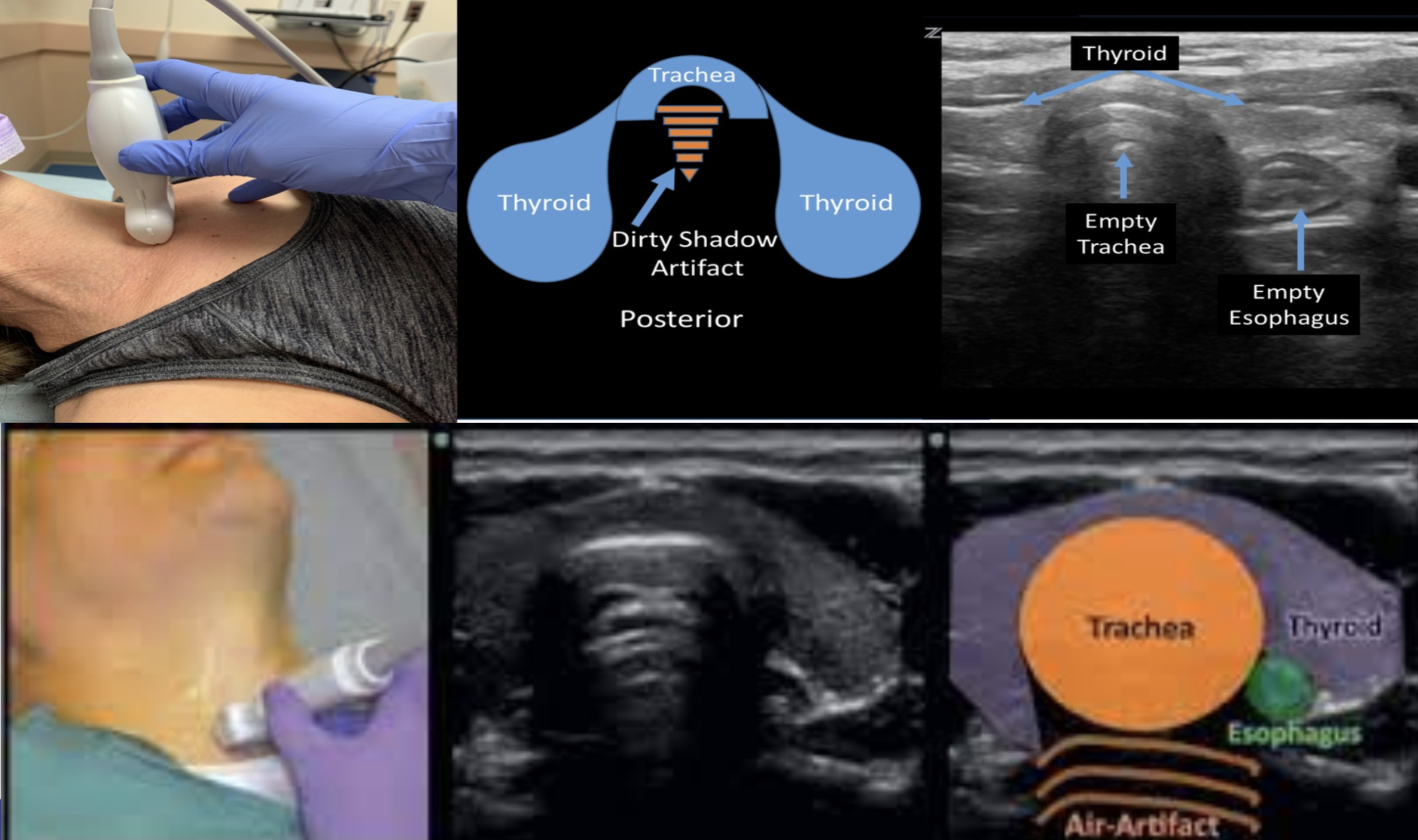 Visualizing an ETT on Ultrasound — Kwak Talk